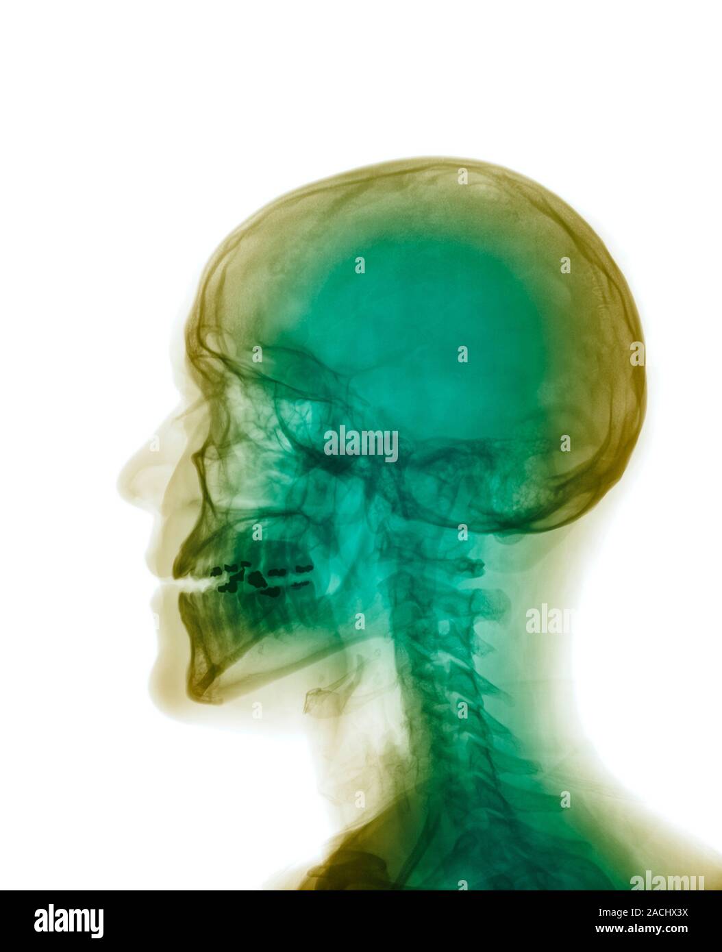 Human head. Coloured X-ray of a Caucasian man's head Stock Photo - Alamy