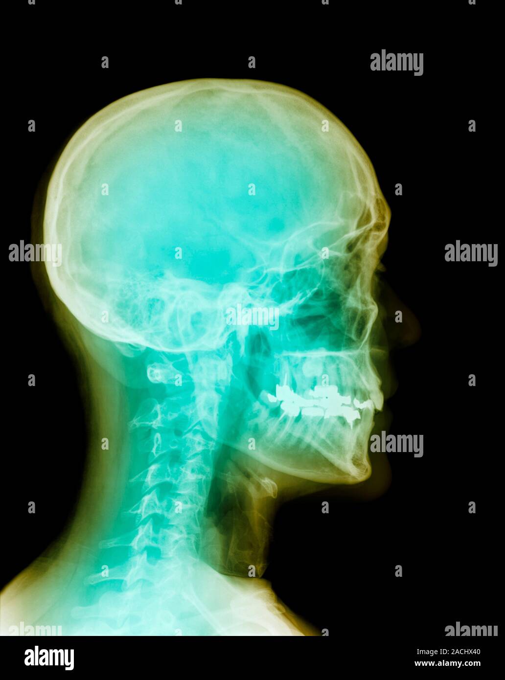 Human head. Coloured X-ray of a Caucasian man's head Stock Photo - Alamy
