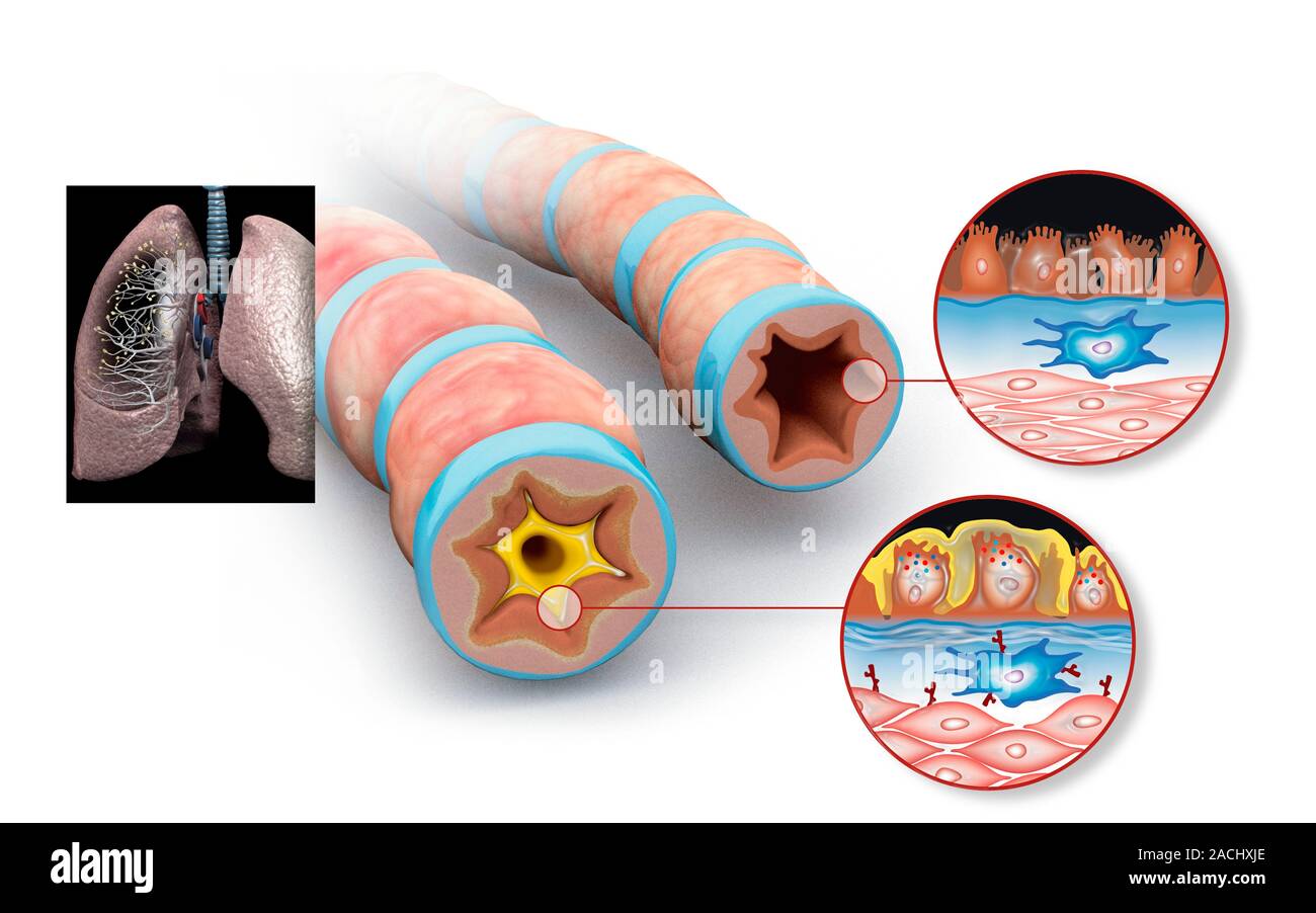 Asthma pathology. Computer artwork showing cross-sections through a ...