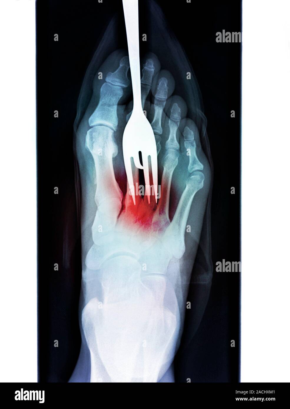 Foot fork-stabbing injury, coloured X-ray. The fork (white, top) has ...