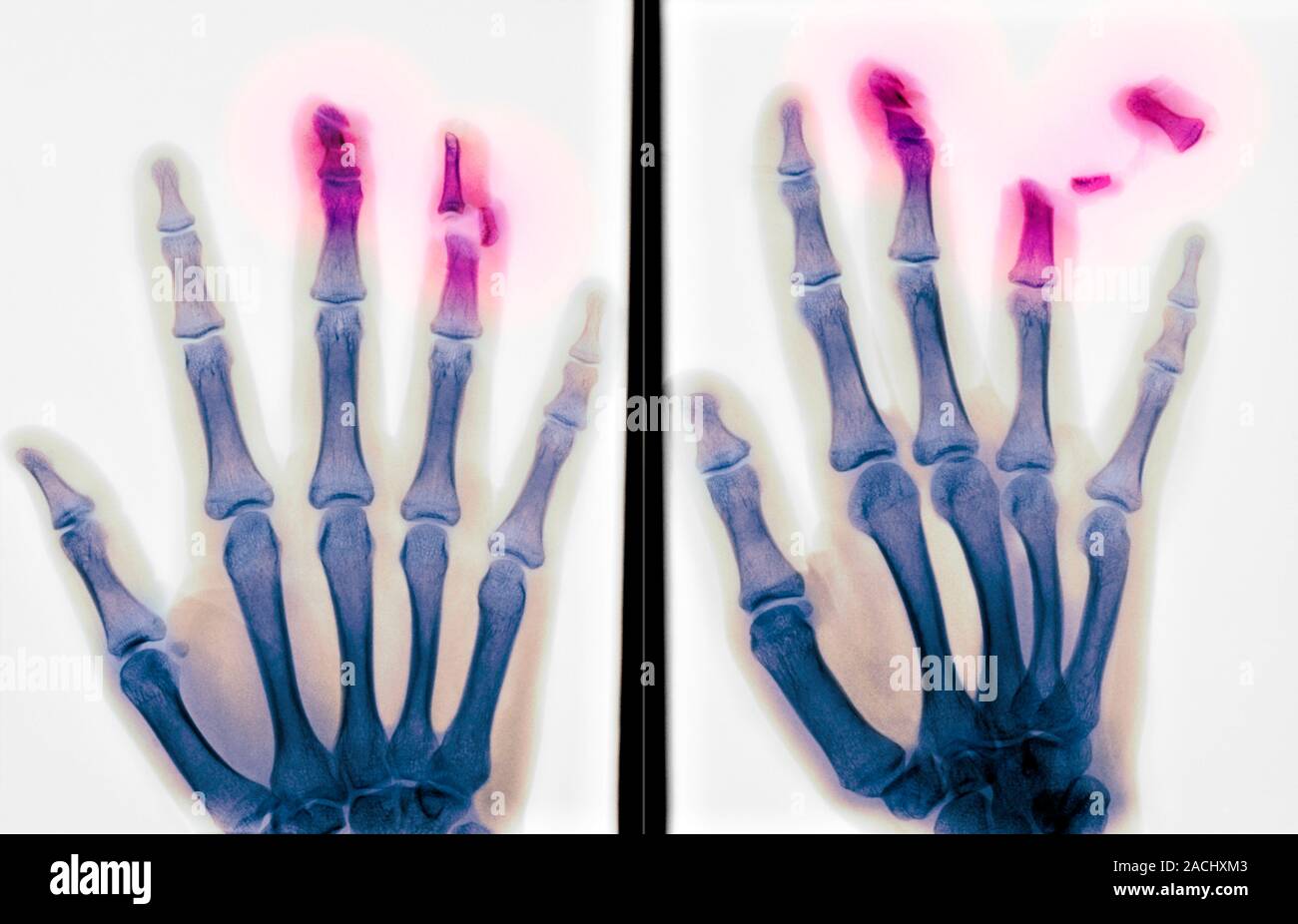 Fingertip laceration injuries, coloured X-rays. Both X-rays show the ...