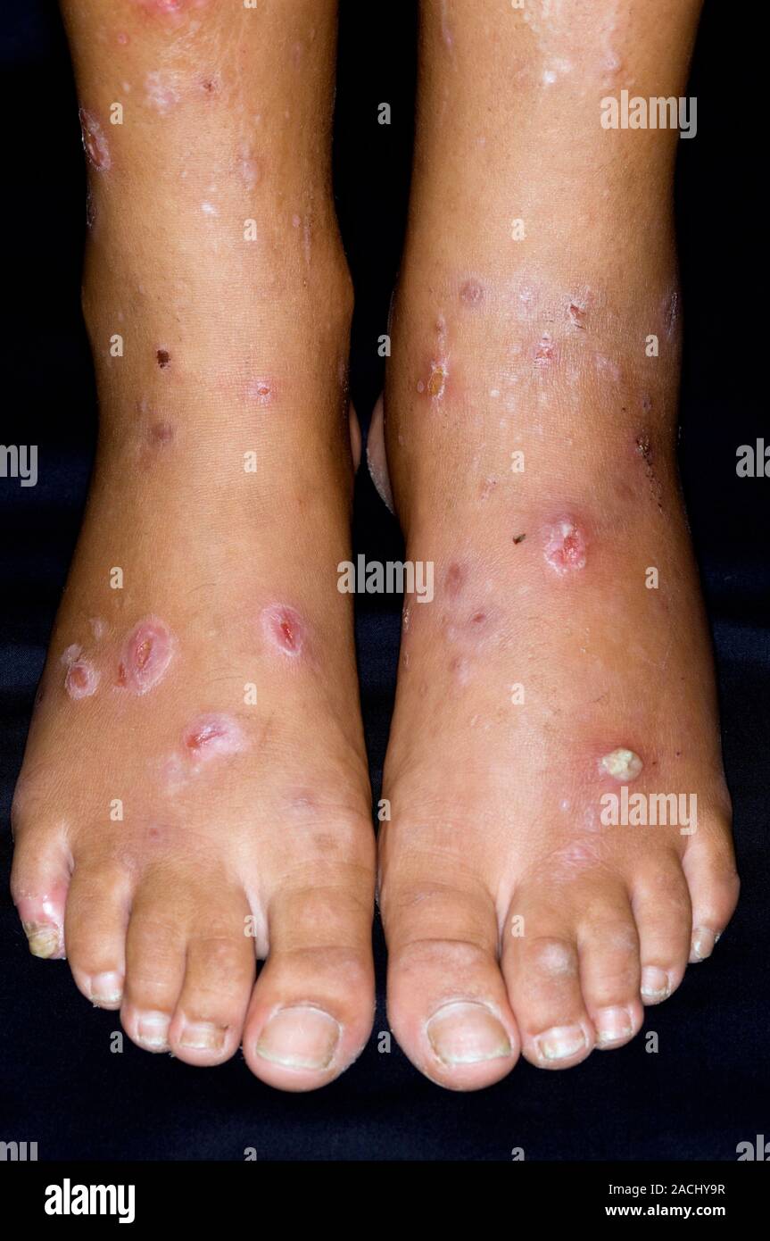 Infected insect bites on the skin of the feet in a 19 year old female ...
