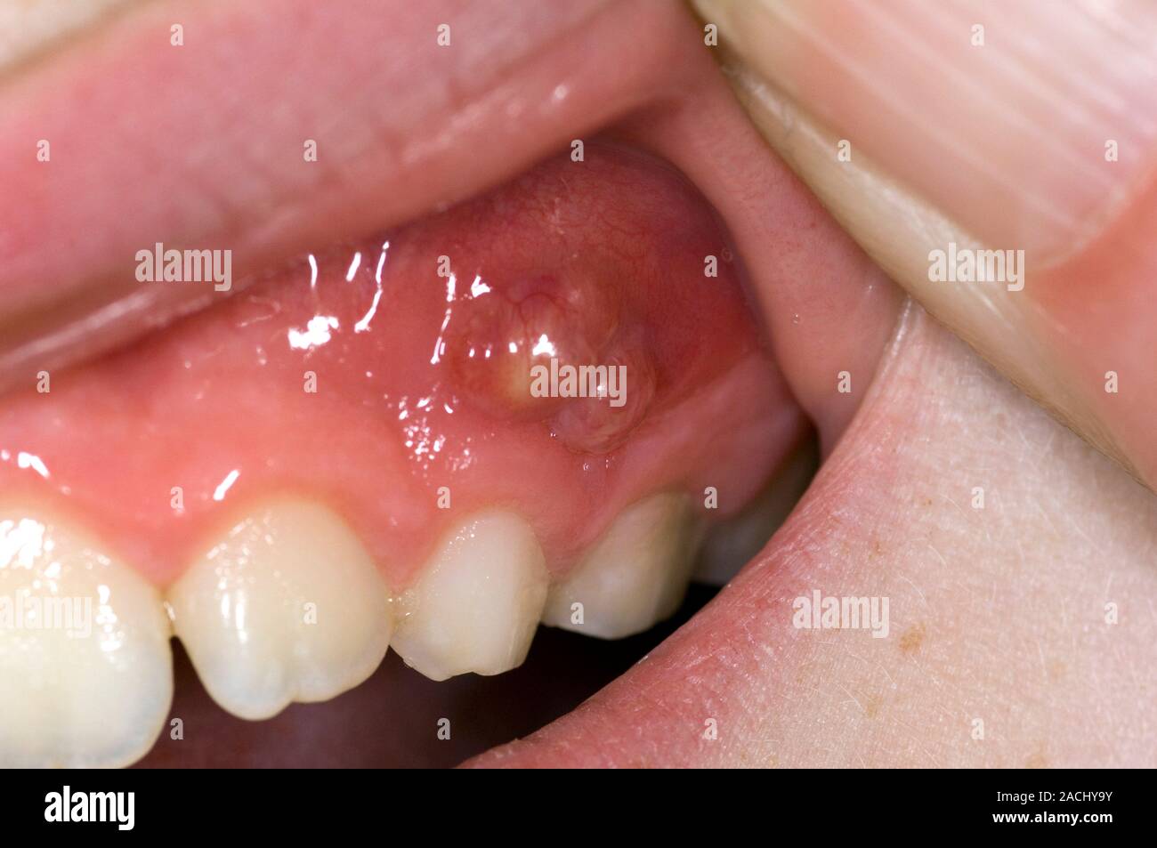 Close-up of an abscess in the gum of the mouth in a 9 year old female ...