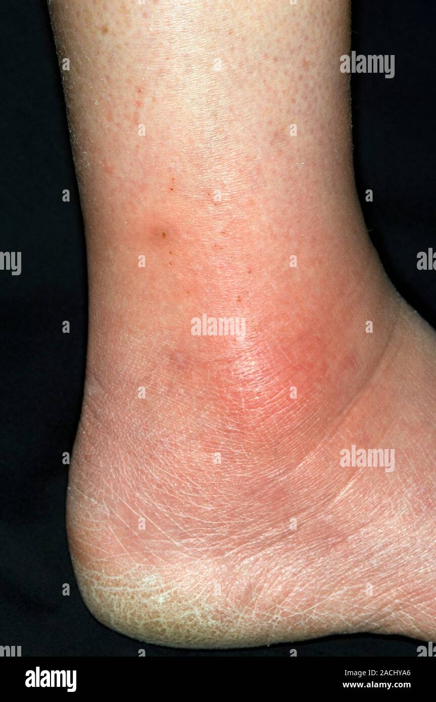 Swollen and red ankle in a 48 year old female patient due to an ...