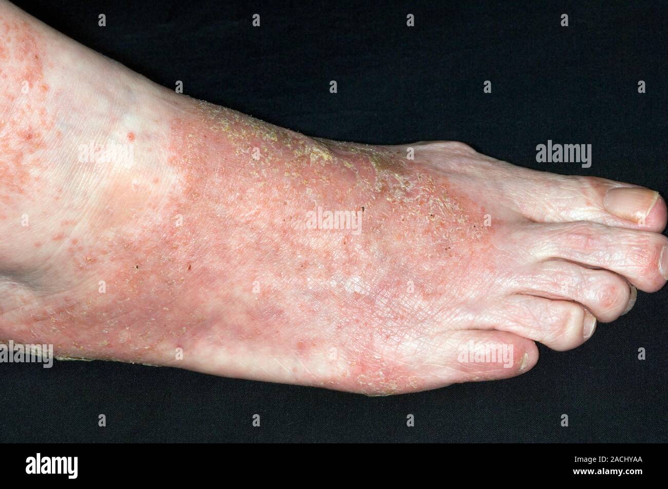 Infected eczema on the foot in a 70 year old alcoholic female patient ...