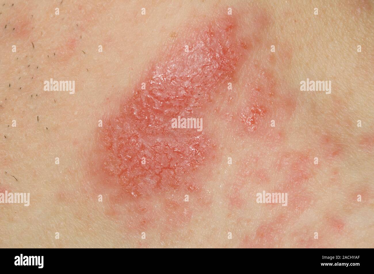 Close-up of infected eczema on the neck in a 58 year old male patient ...