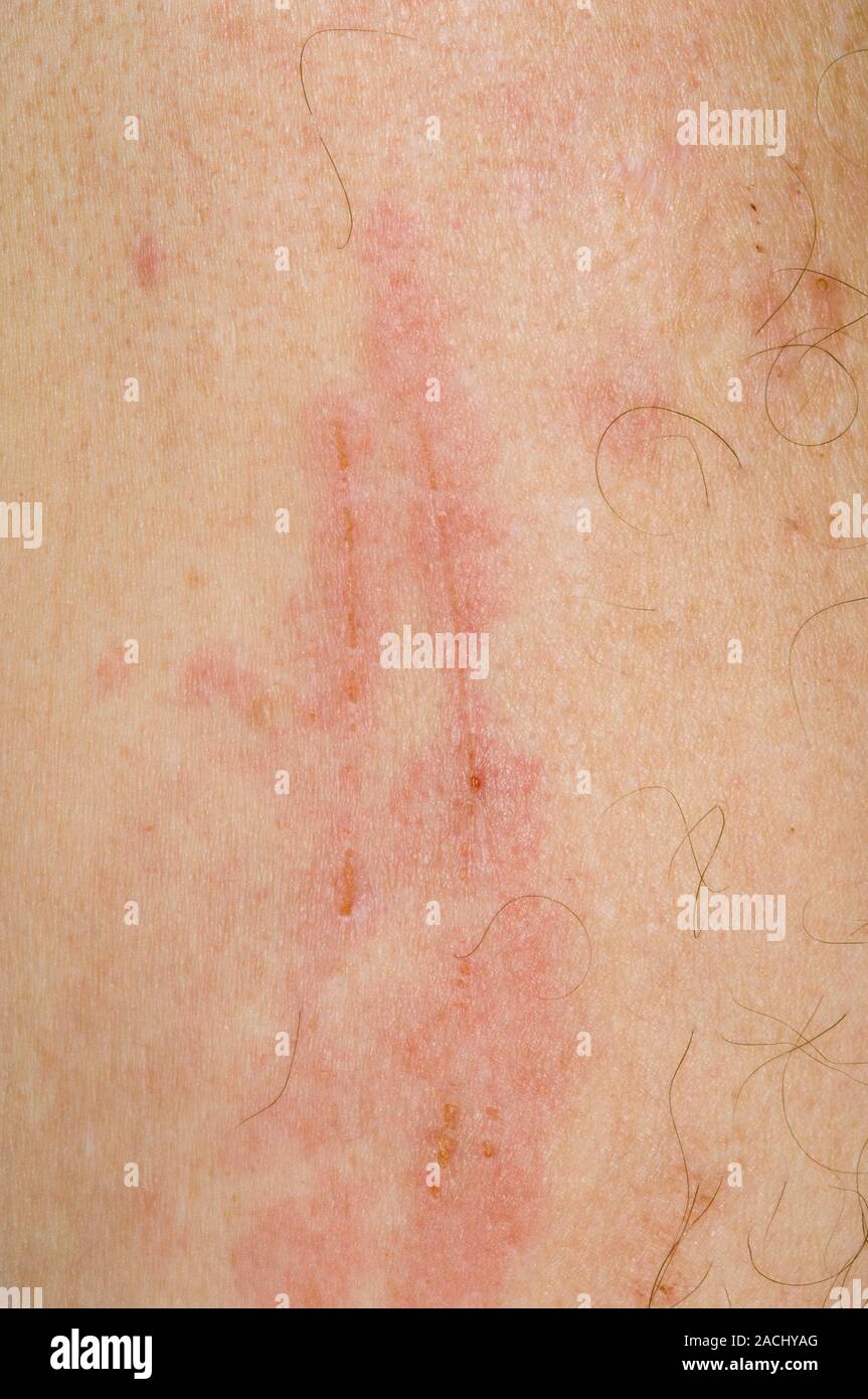 Close-up of scratch marks on the arm in a 58 year old male patient with ...