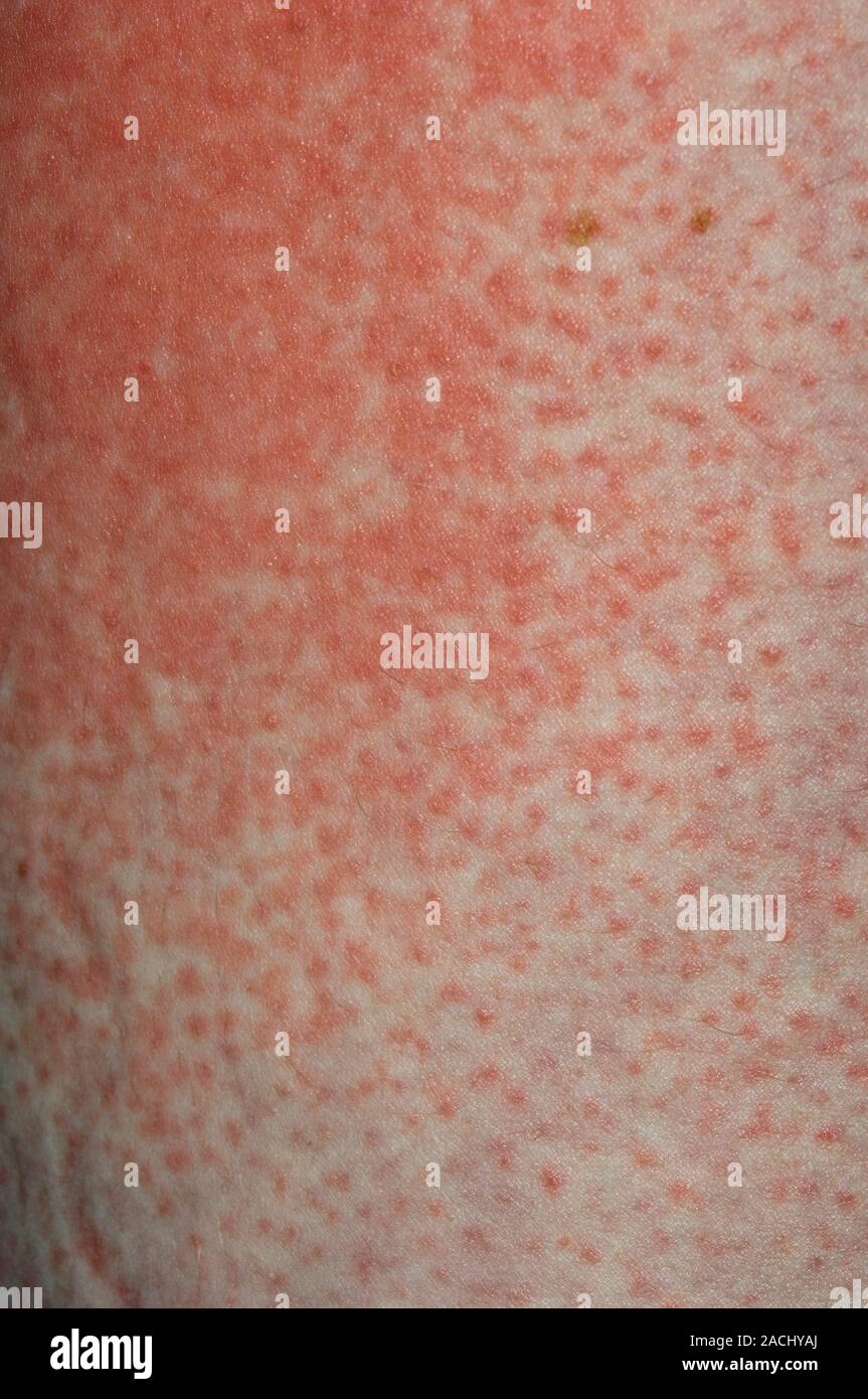 Close-up of an urticaria rash on the thigh in an 18 year old female ...