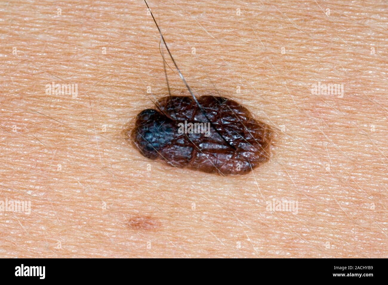 Close-up of a melanocytic naevus (mole) on the skin in a 26 year old ...