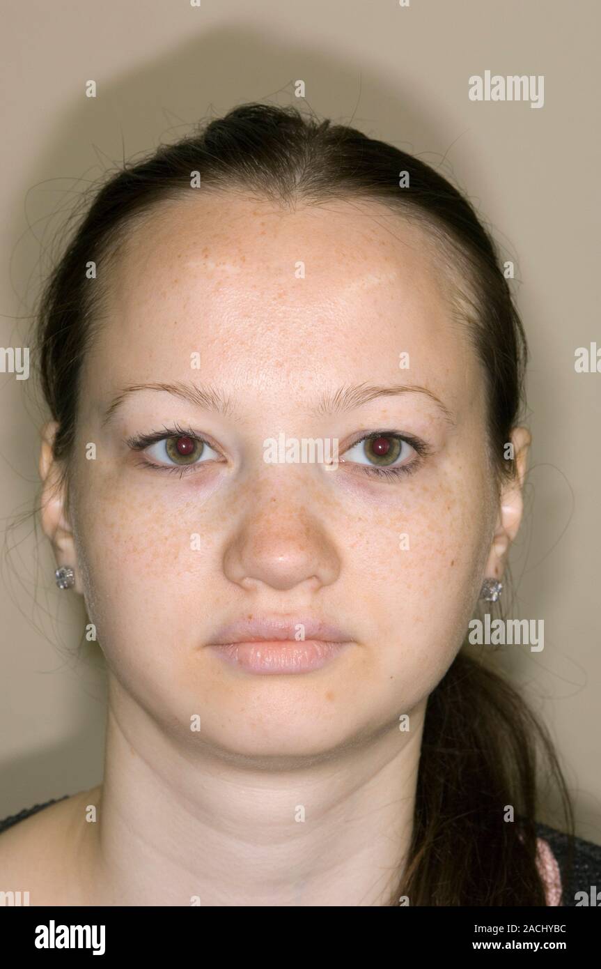 Pale skin (pallor) due to anaemia (Haemoglobin 69) in a 24 year old ...