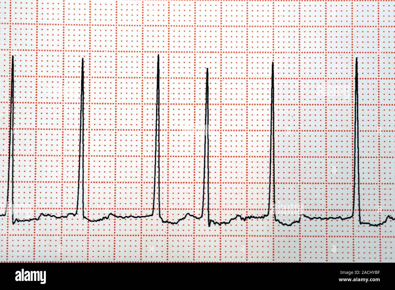 Echocardiogram (ECG) showing atrial fibrillation (AF) of the heartbeat ...