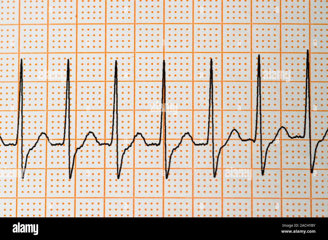 Echocardiogram (ECG) showing junctional rhythm of the heartbeat, an ...