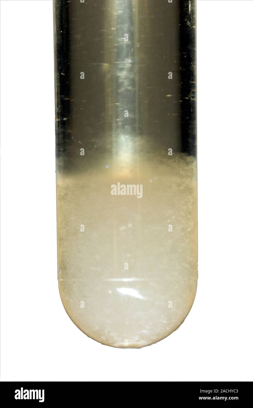 Sample of urine from a patient showing a white cloudiness due to the ...