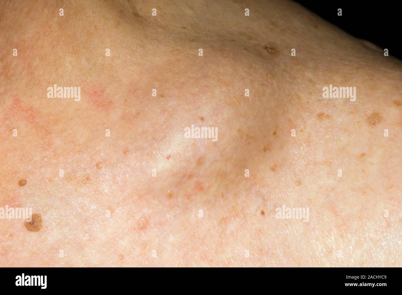 Close-up of the swollen lymph node (lymphadenopathy) in an 82 year old ...