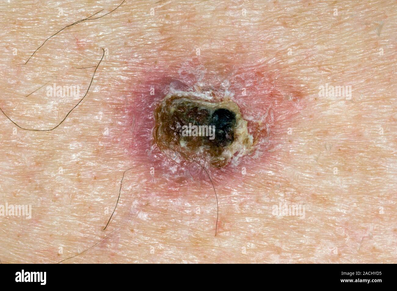Close-up of skin cancer (basal cell carcinoma) on the shoulder in a 73 ...