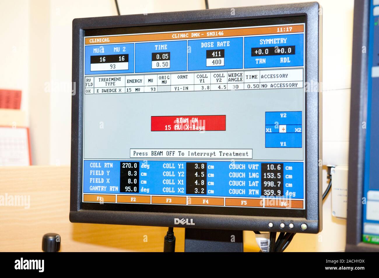 Digital display on a radiotherapy monitor during radiation treatment ...