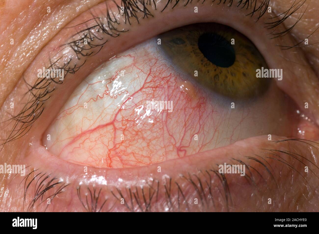 Close Up Of The Red Eye In A 65 Year Old Female Patient With Episcleritis An Inflammation And