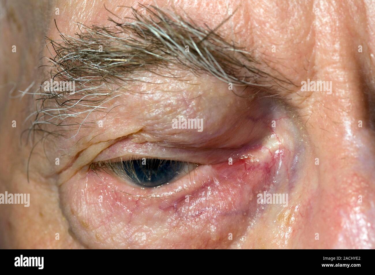 Close-up of the inflamed upper eyelid in an 89 year old male patient ...