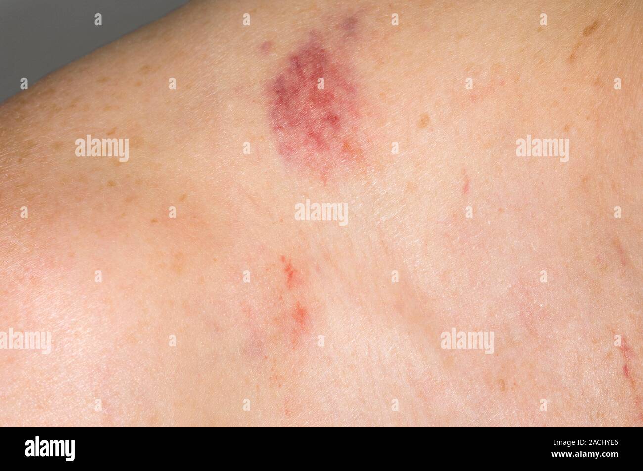 Bruise On Shoulder