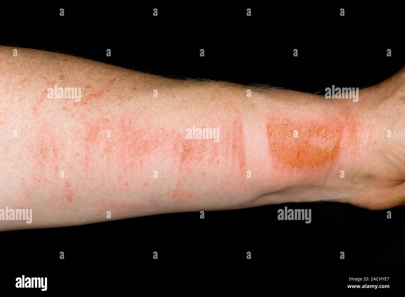 Close-up of the grazed arm in a 48 year old female patient caused by an ...