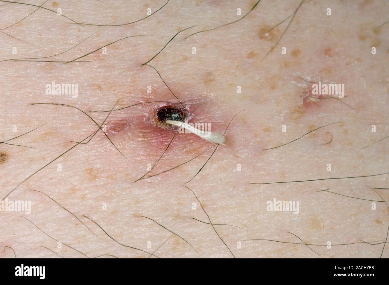 Close-up of a suture (stitch) which should have dissolved in the skin ...
