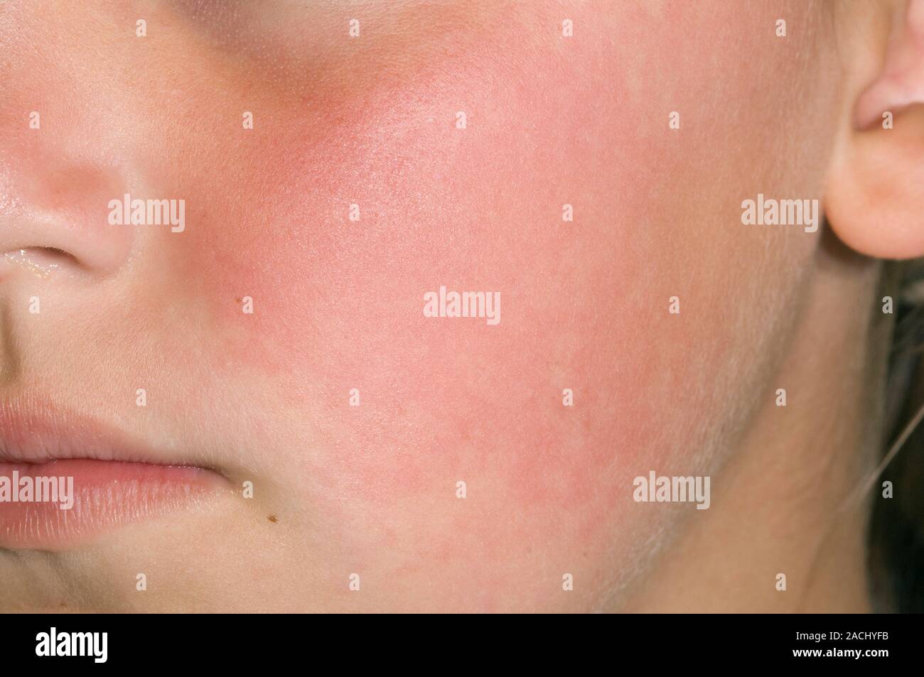 Close-up of the red cheek in a 9 year old girl with Fifth disease ...