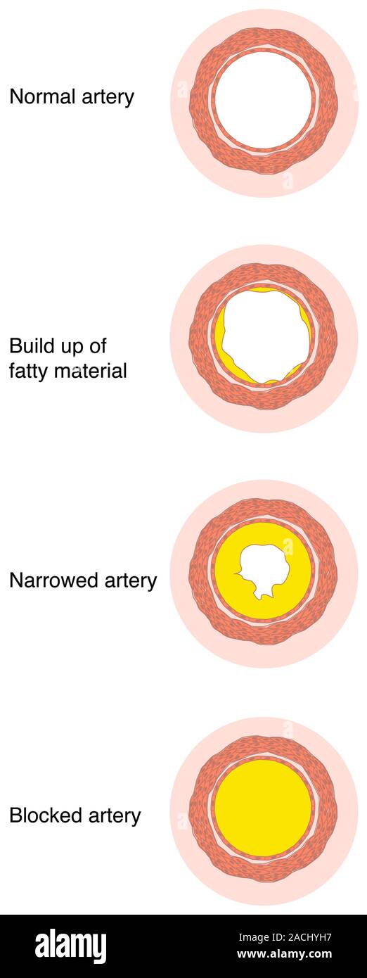 Narrowed blood vessel. Artwork showing a blood vessel that is ...
