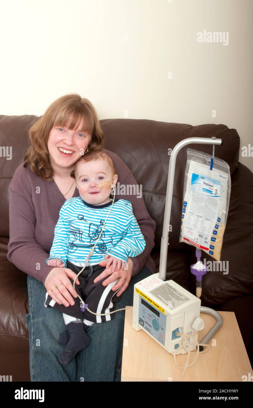 Nasogastric tube. 18-month-old infant being fed through a nasogastric ...