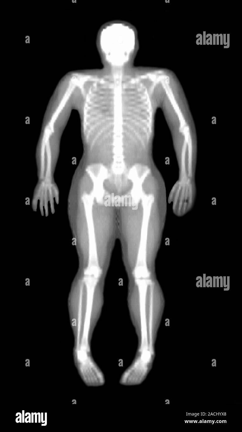 Bone density scan. Dual energy X-ray absorptiometric (DXA) scan of a ...