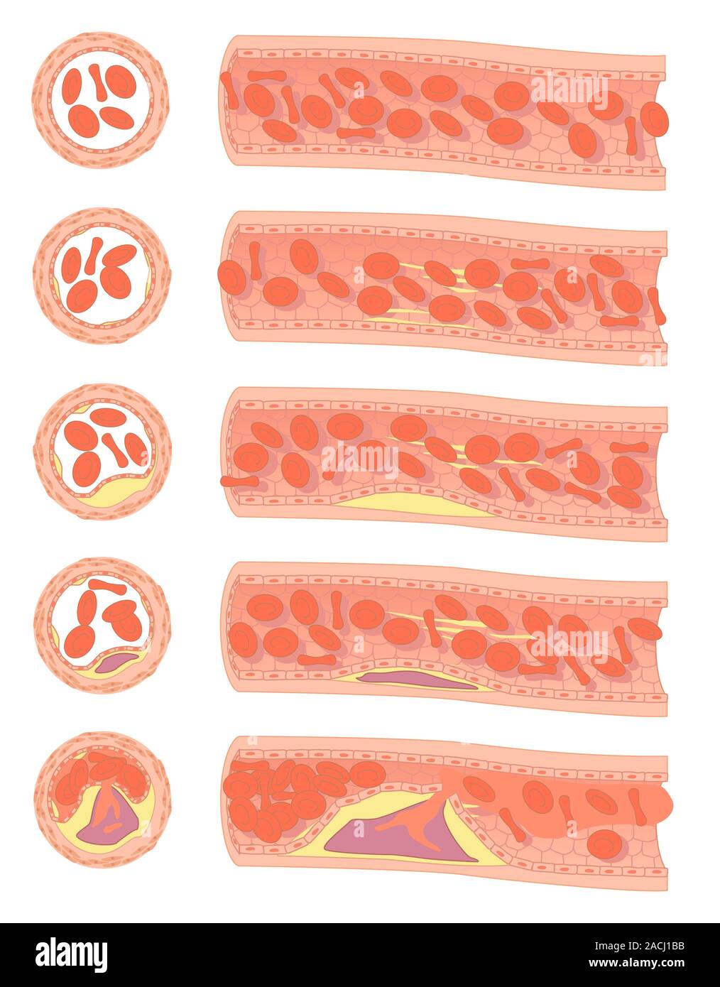 Vascular disease progression. Artwork showing the progression of ...