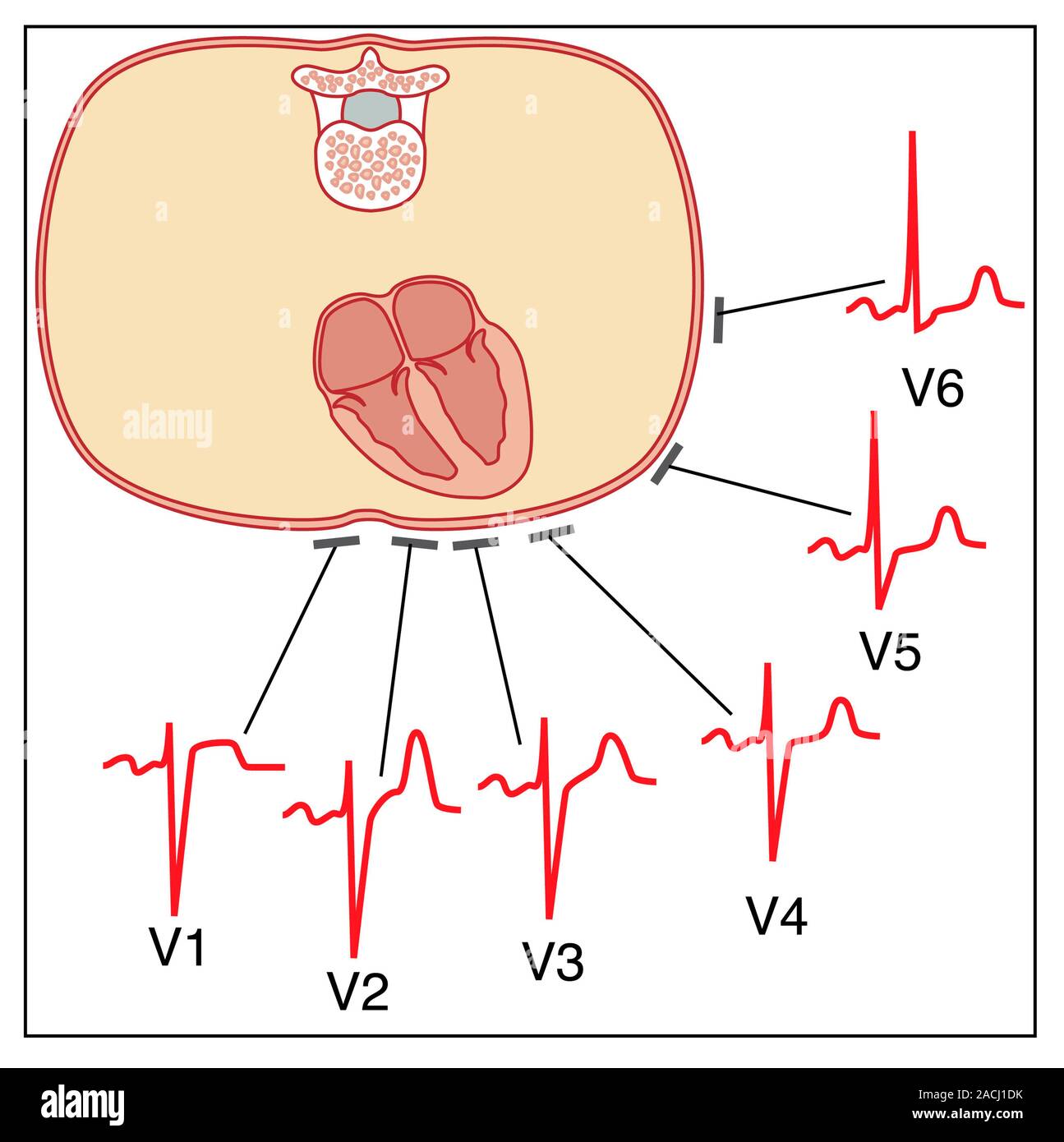 Placing of electrodes for electrocardiogram (ECG), artwork. This ...