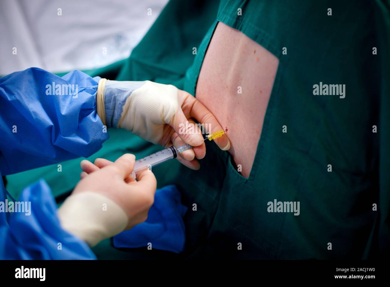 Spinal anaesthesia. Anaesthetist injecting a local anaesthetic into a ...