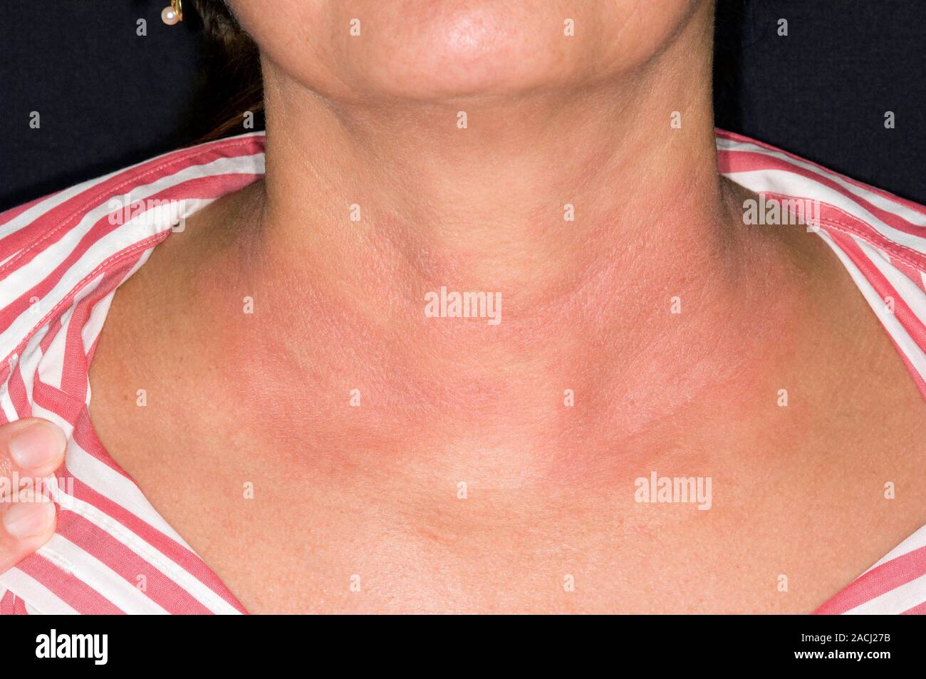 Skin reddening and scaling on the neck in a 53 year old female patient ...