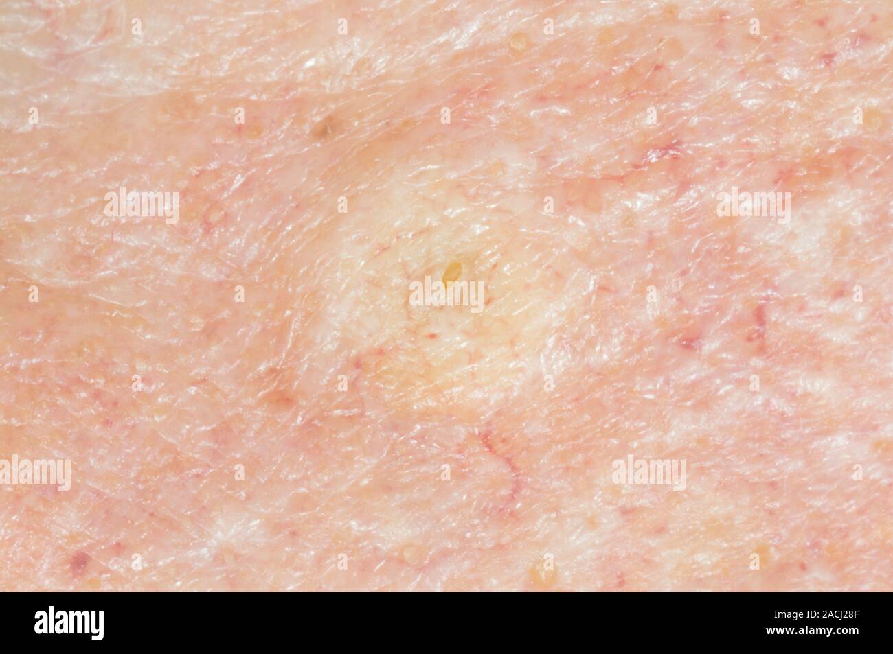 Close-up of a blackhead on the nose in an 82 year old male patient. A ...