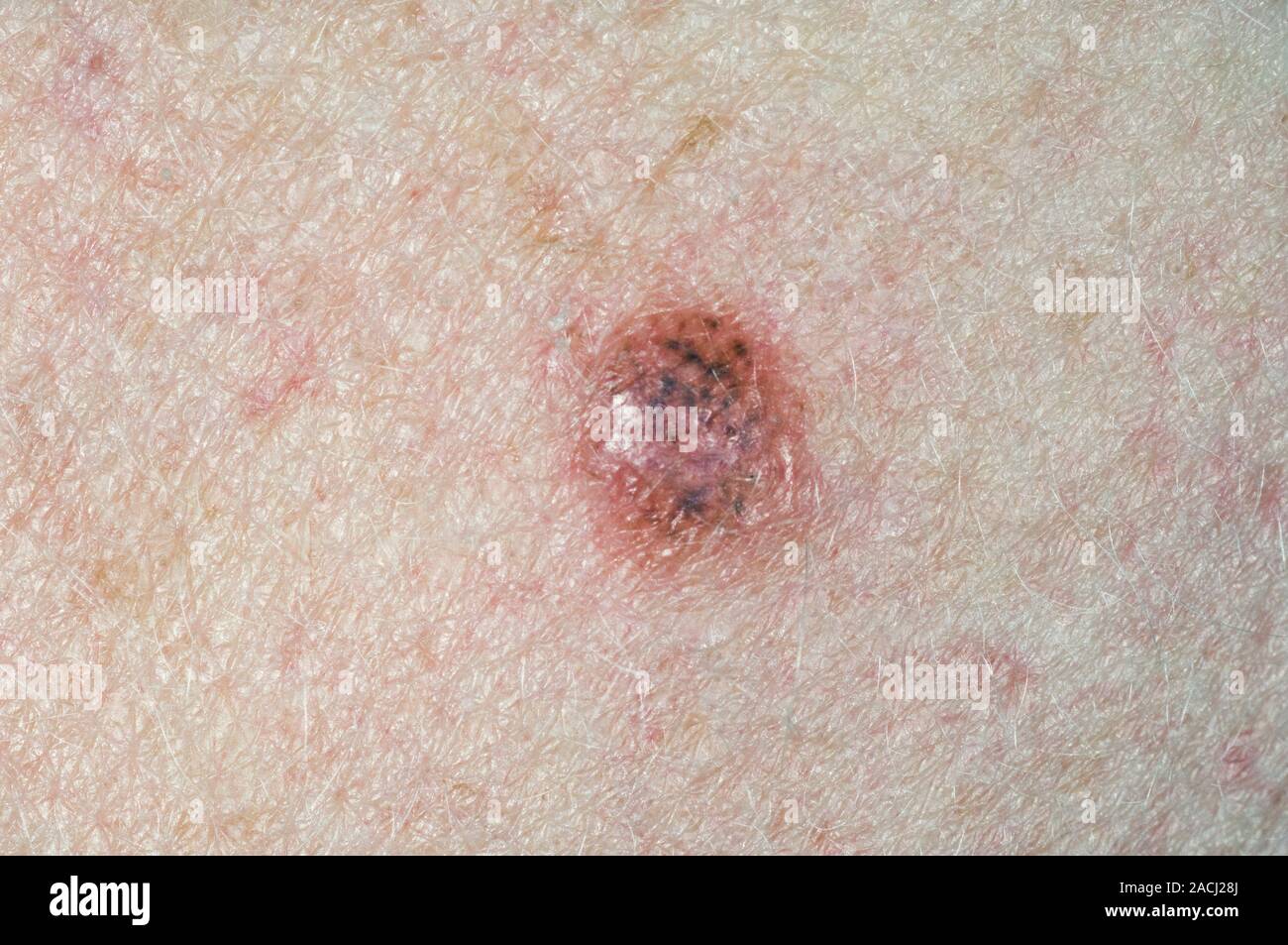 Close-up of an inflamed compound naevus (mole) on the skin in a 34 year ...