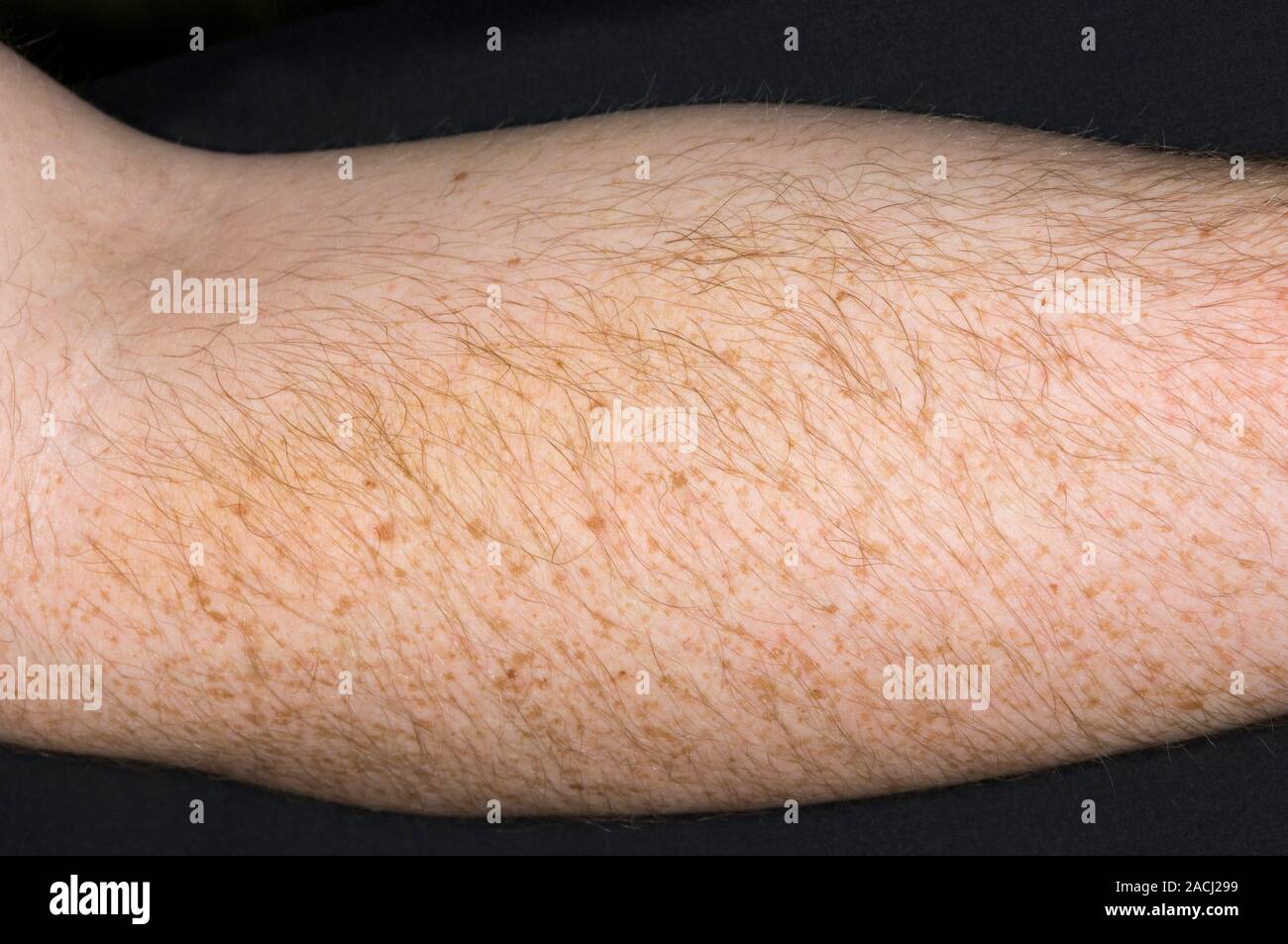 Cafe au lait spots on the skin of the arm in a 20 year old male patient ...