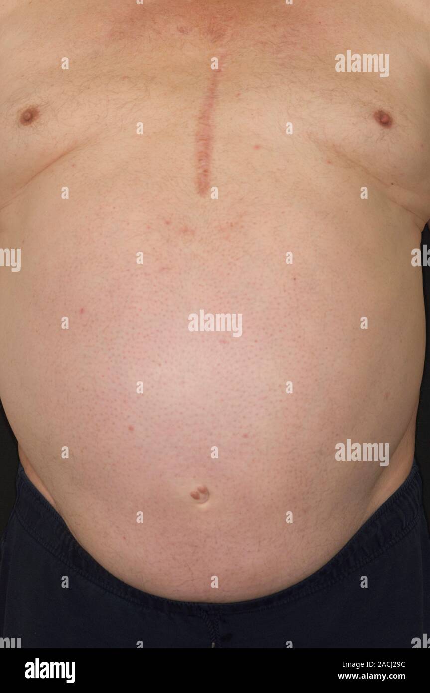 Front view of the swollen abdomen in a 67 year old male patient with ...