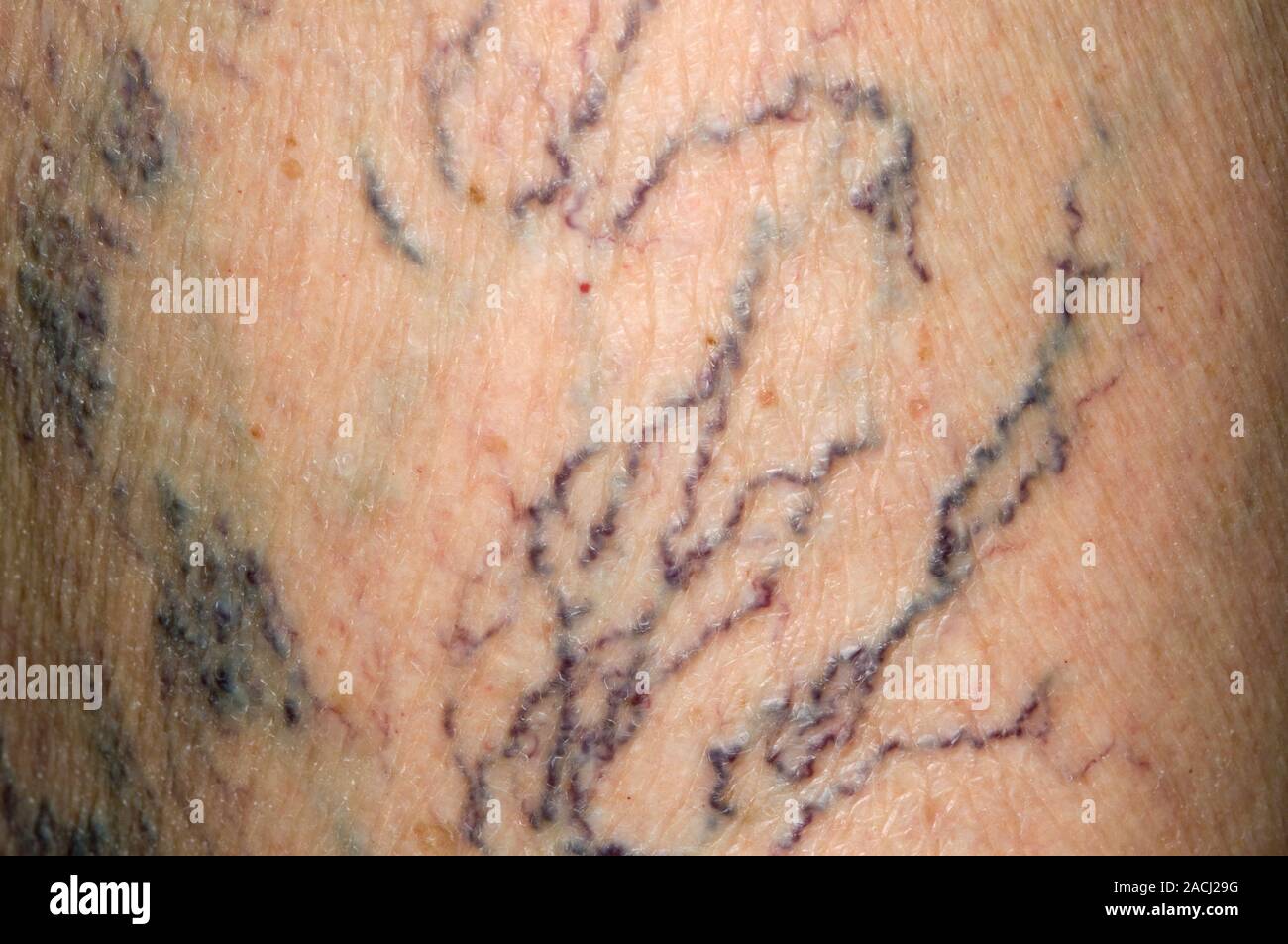 Close-up of superficial thread veins on the skin in a 69 year old ...