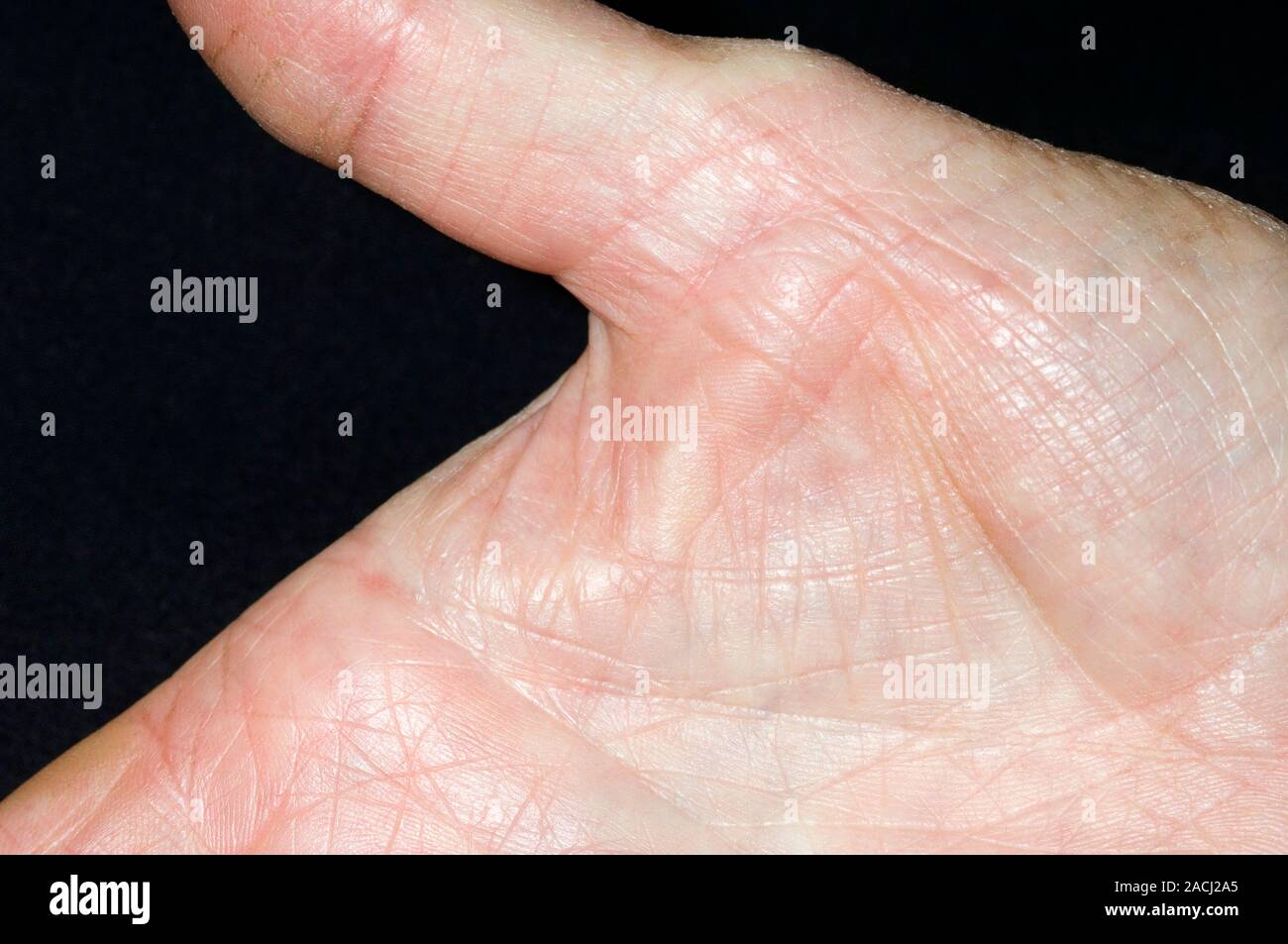 Close-up of the palm of the hand in a 69 year old male patient with ...