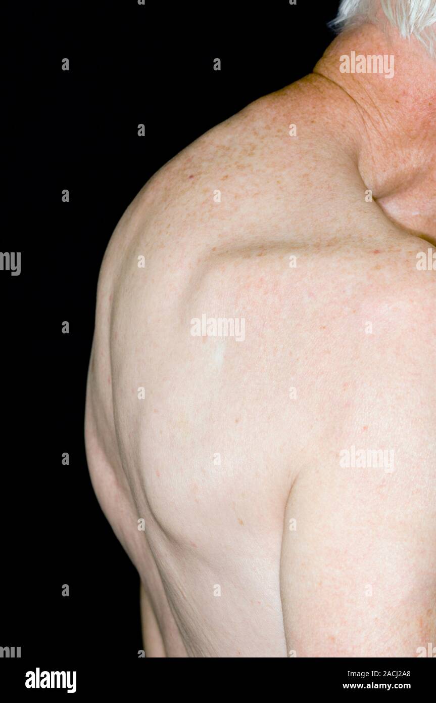 Curved spine (kyphosis or hunchback) due to osteoporosis (brittle bone ...