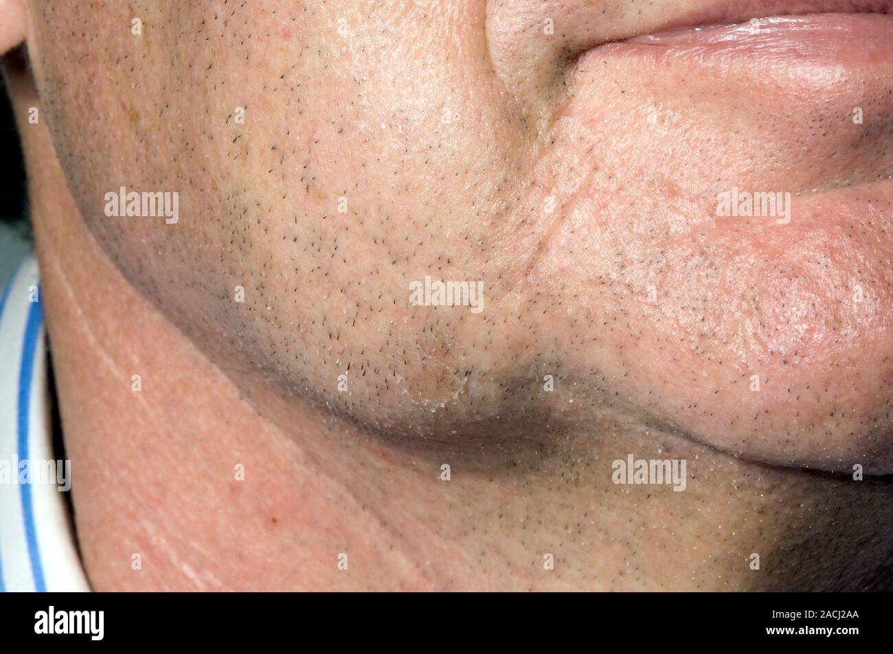 Fibrotic nodule (lump) in the cheek in a 58 year old male patient ...
