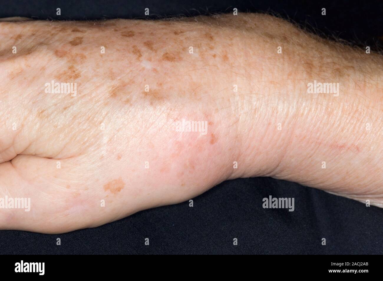 Red and acutely inflamed wrist in an 80 year old female patient due to ...