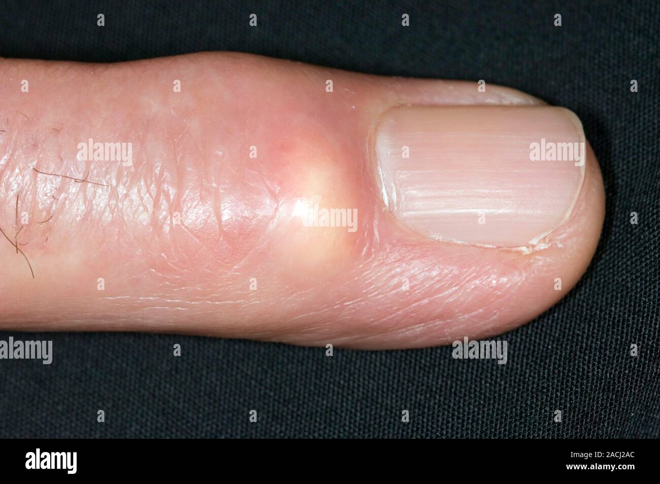Close-up of a gout tophus on the finger in an 81 year old female ...