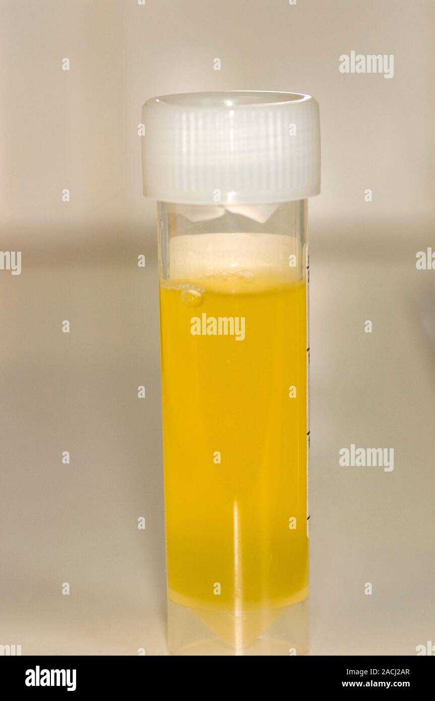Sample bottle of aspirated fluid from a swollen knee joint in a 27 year ...