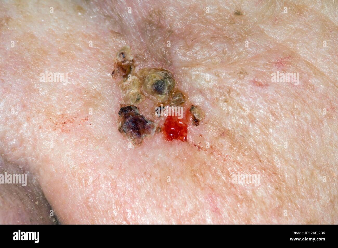 Close-up of basal cell carcinoma (skin cancer) on the cheek of the face ...