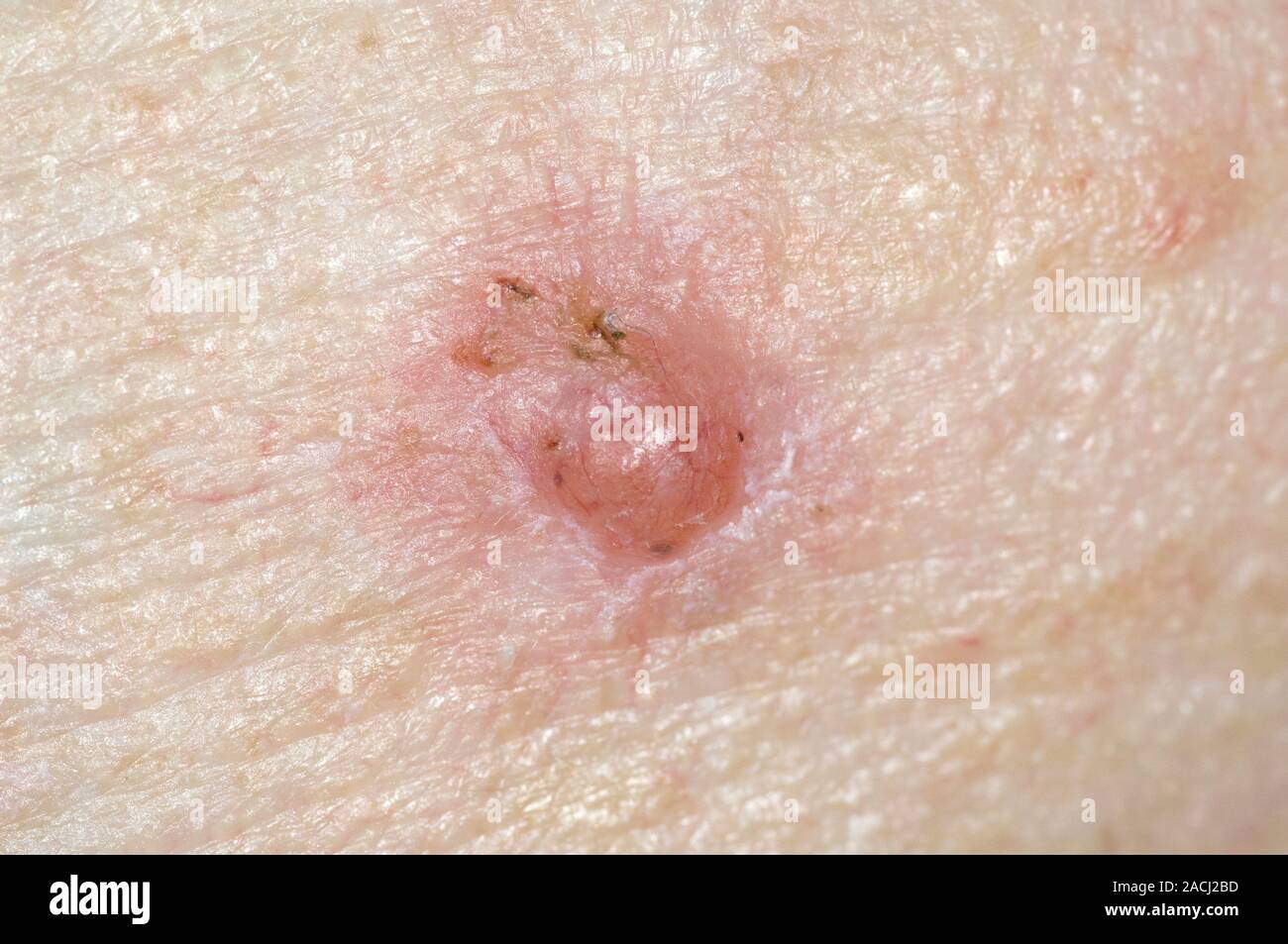 Close-up of basal cell carcinoma (cancer) on the skin in a 73 year old ...