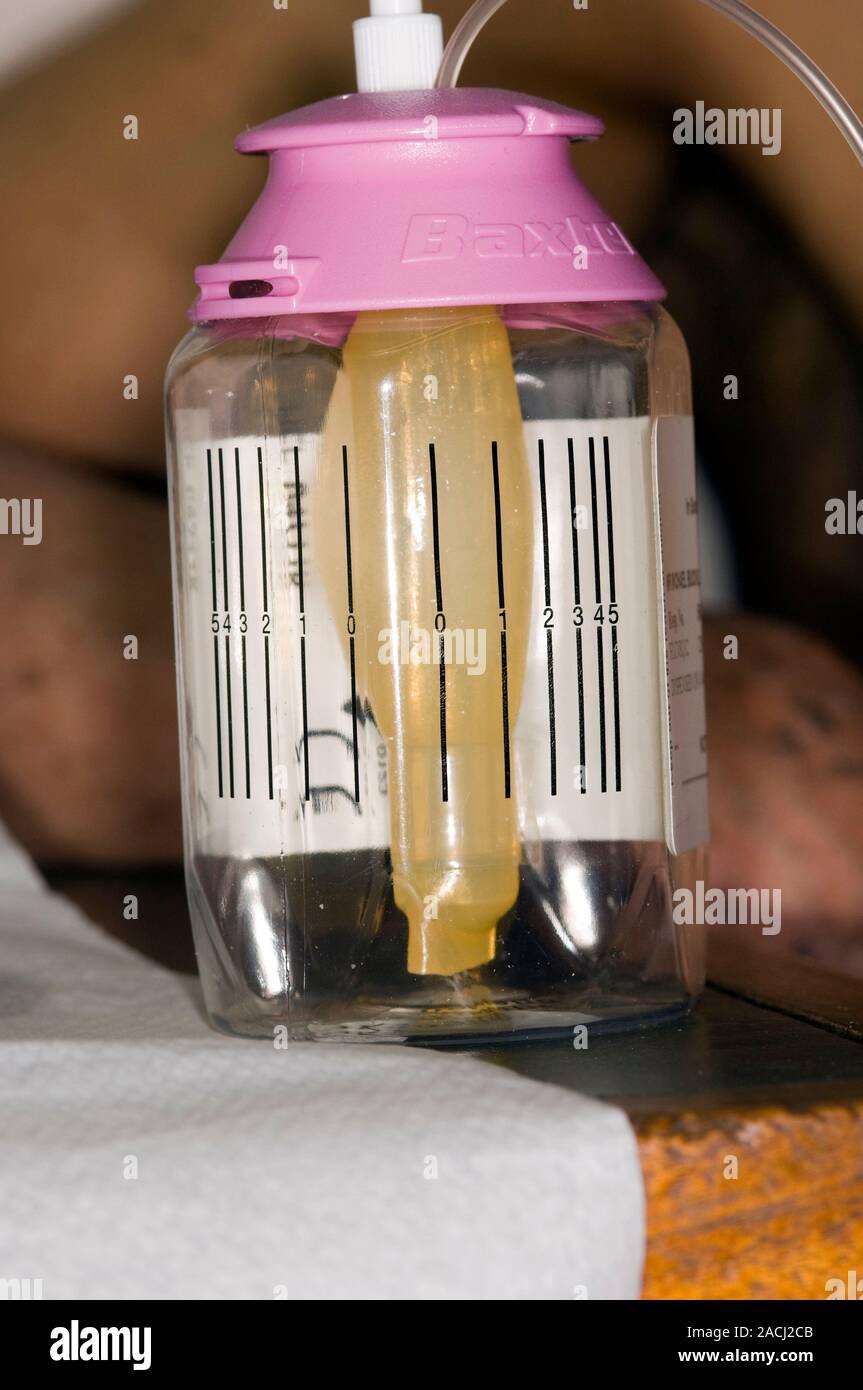 Intravenous bottle used for chemotherapy (with 5 fluoro uracil: 5FU) in ...