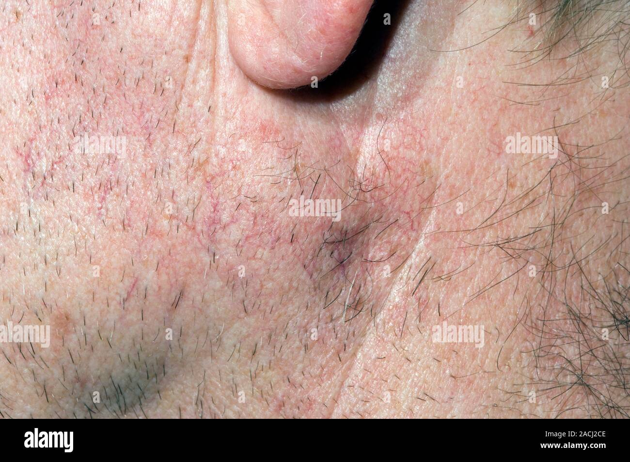 Lymph node enlargement (lymphadenopathy) in the neck in a 72 year old ...