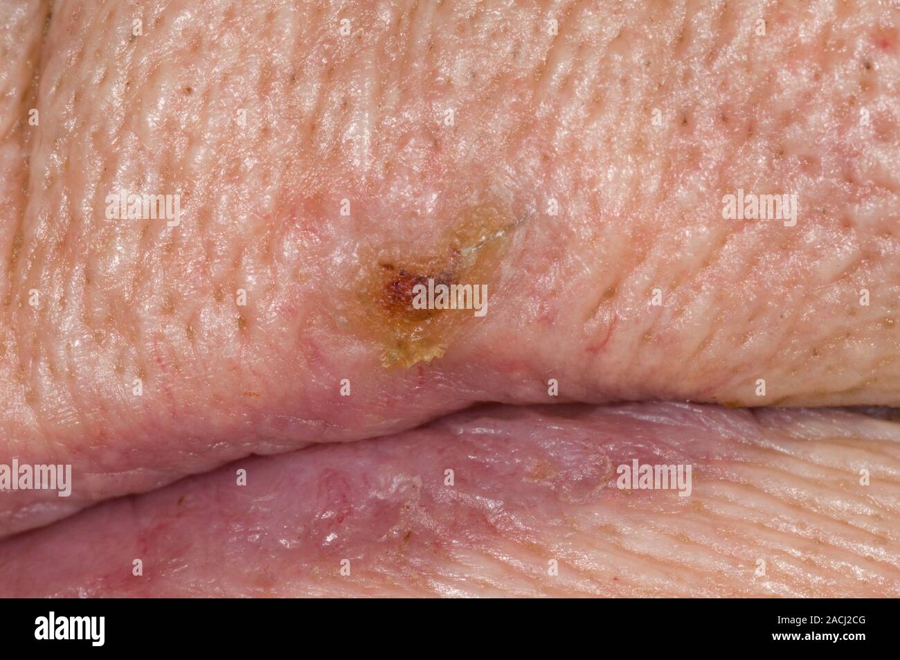 Close-up of basal cell skin cancer (carcinoma) on the lip of the mouth ...