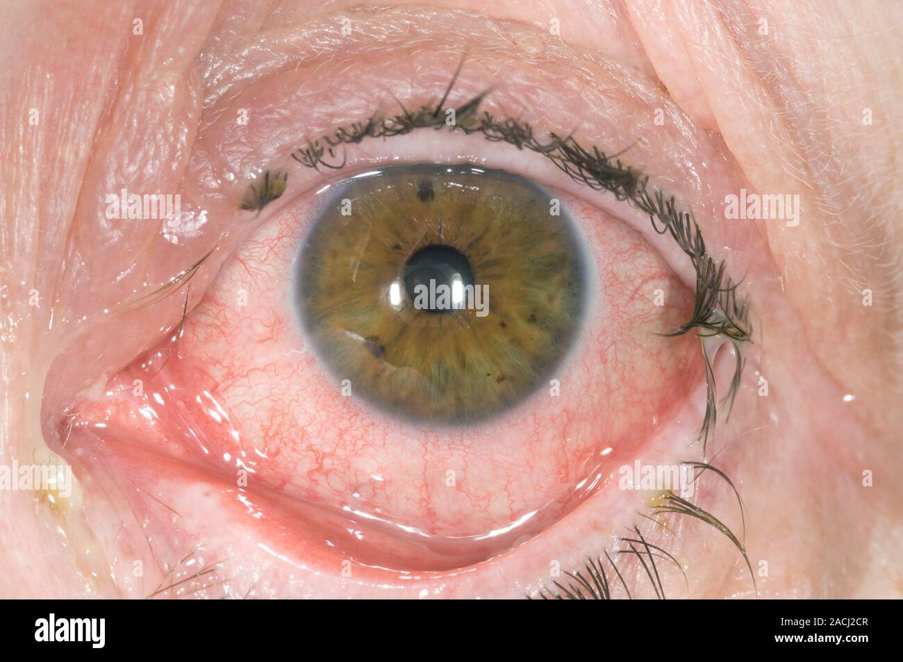 Close-up of the red eye in a 60 year old female patient due to ...